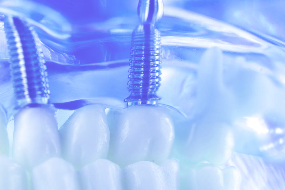 Dental Implants – mlimplants